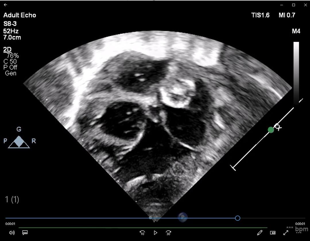 การใช้ Echocardiography guide Balloon atrial septostomy in cyanotic ...
